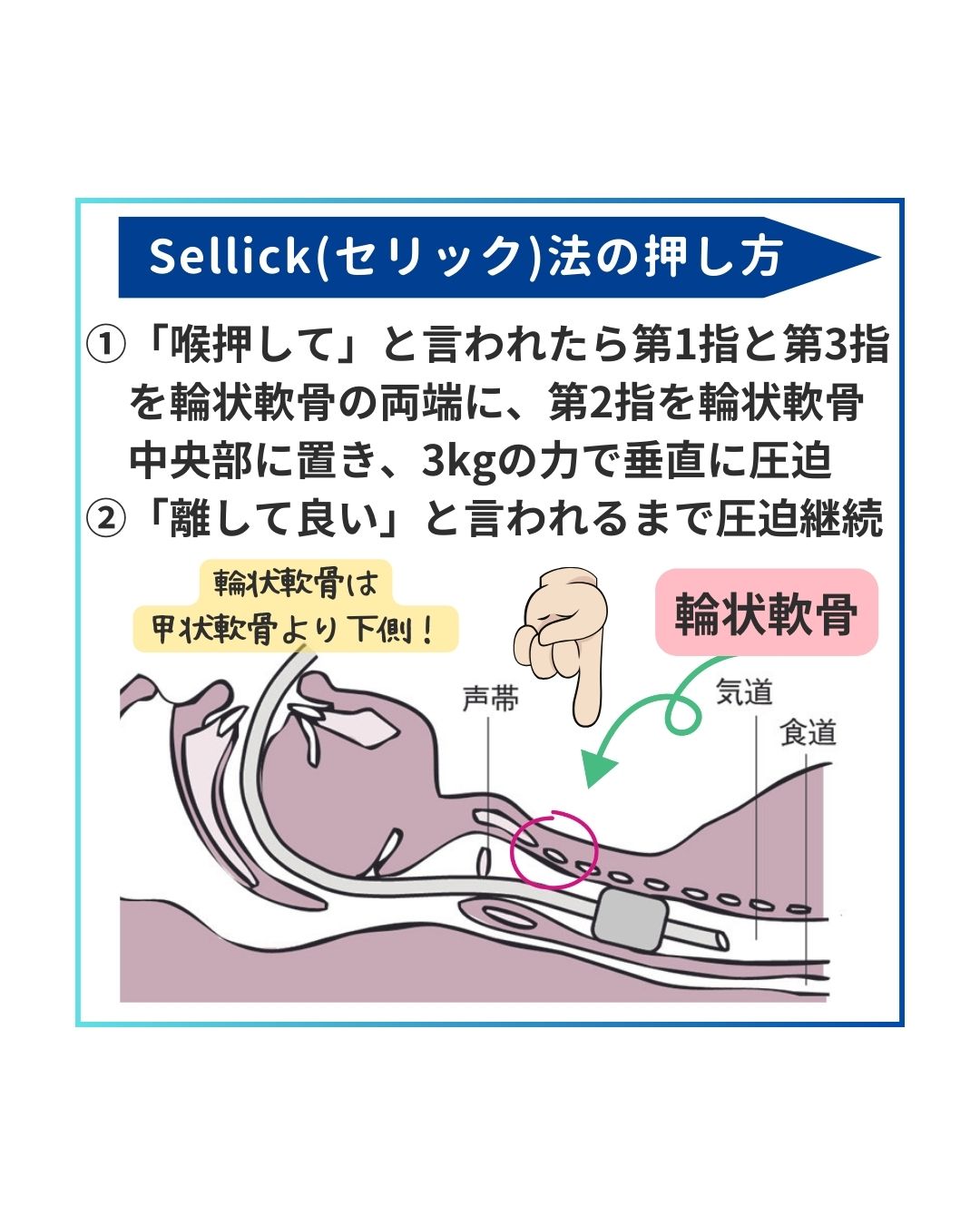 【オペ看勉強用】BURP(バープ)法とSellick(セリック)法はどう違う？挿管介助での喉の押し方を解説！ | 【オペ看が楽しくなる！】